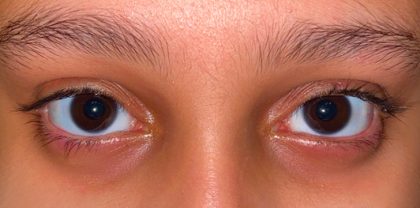 Patient #268 Lesion Removal Before and After Photos Chicago, IL ...