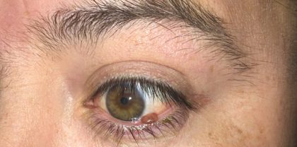 Patient #262 Lesion Removal Before and After Photos Chicago, IL ...