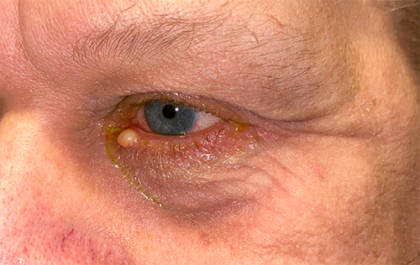 Patient #352 Lesion Removal Before and After Photos Chicago, IL ...