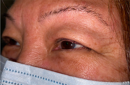 Patient #354 Lesion Removal Before and After Photos Chicago, IL ...