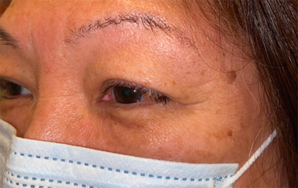 Patient #354 Lesion Removal Before and After Photos Chicago, IL ...