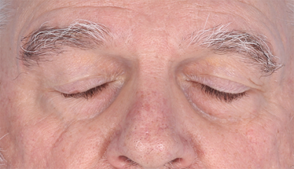 Patient #357 Lesion Removal Before and After Photos Chicago, IL ...