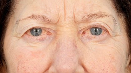 Patient #829 Tepezza Before and After Photos Chicago, IL - Plastic ...