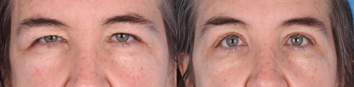 Best Blepharoplasty Chicago, IL | Chicago Oculofacial Plastic Surgery