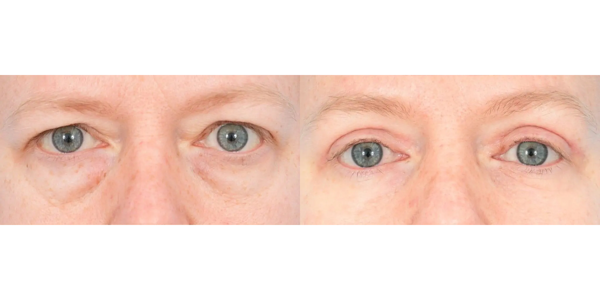 Best Quad Blepharoplasty Chicago, IL | Chicago Oculofacial Plastic Surgery
