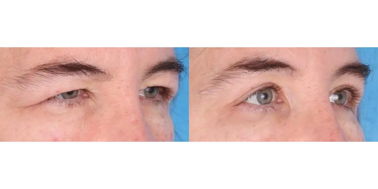 Best Upper Blepharoplasty Chicago, IL | Chicago Oculofacial Plastic Surgery