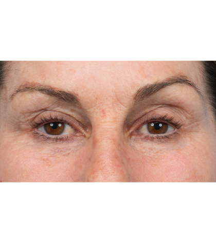 Patient #3418 Revision Blepharoplasty Before and After Photos Chicago ...