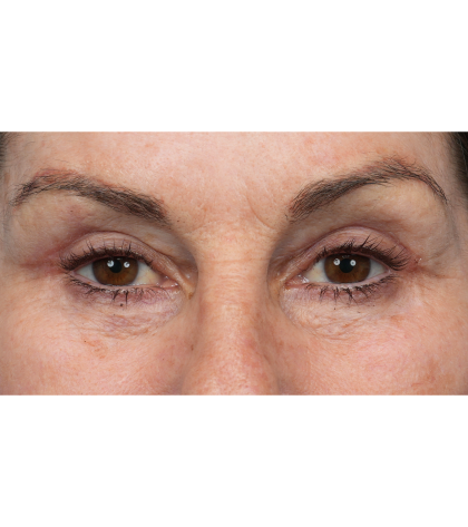 Patient #3418 Revision Blepharoplasty Before and After Photos Chicago ...