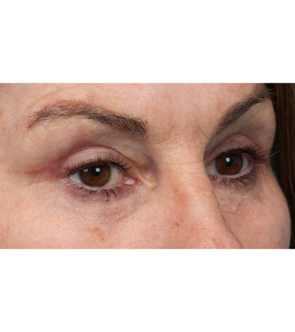 Patient #3418 Revision Blepharoplasty Before and After Photos Chicago ...