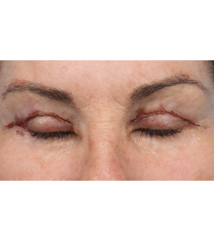 Patient #3418 Revision Blepharoplasty Before and After Photos Chicago ...