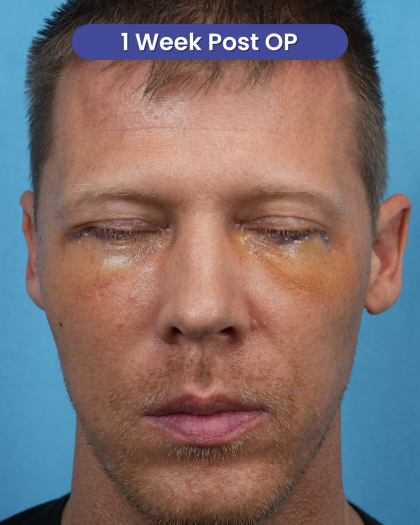 Patient #3467 Lower Blepharoplasty Before and After Photos Chicago, IL ...