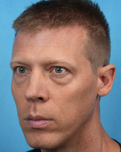 Patient #3467 Lower Blepharoplasty Before and After Photos Chicago, IL ...