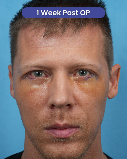 Patient #3467 Lower Blepharoplasty Before and After Photos Chicago, IL ...